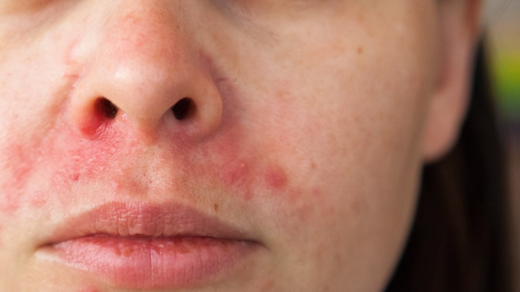 Perioral Dermatitis Causes Symptoms Treatment Gladskin