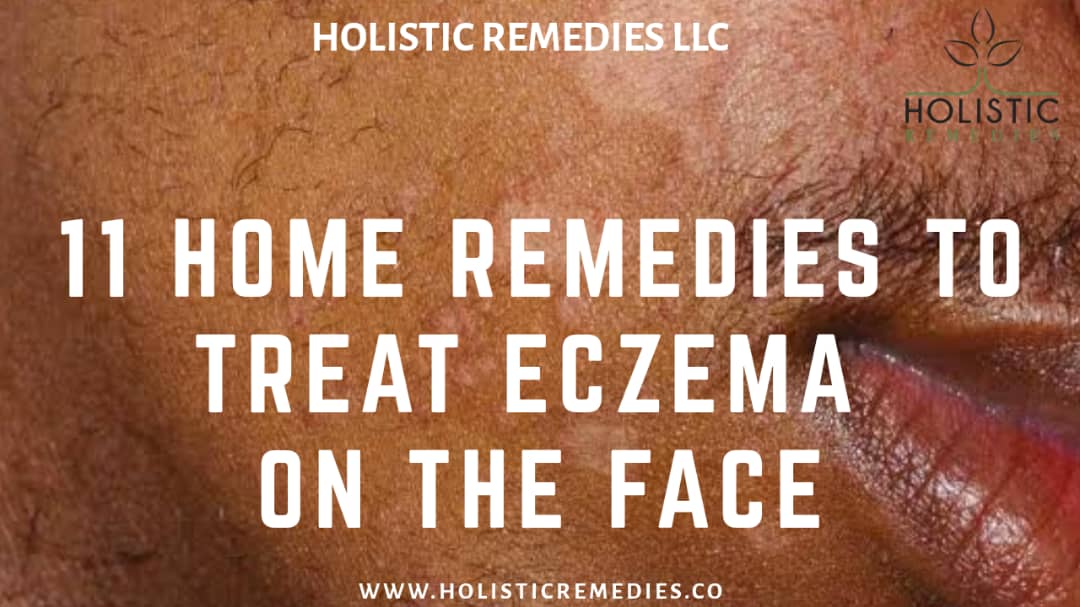 11 Home Remedies To Treat Eczema On The Face Holistic Remedies Llc