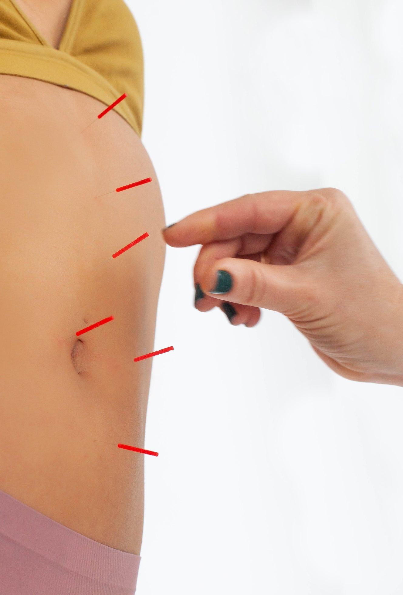 Dry Needling Vs Acupuncture Whats The Difference Wthn