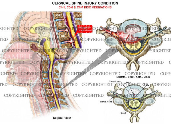 Disc Herniation C6 7 Disc Herniation Symptoms