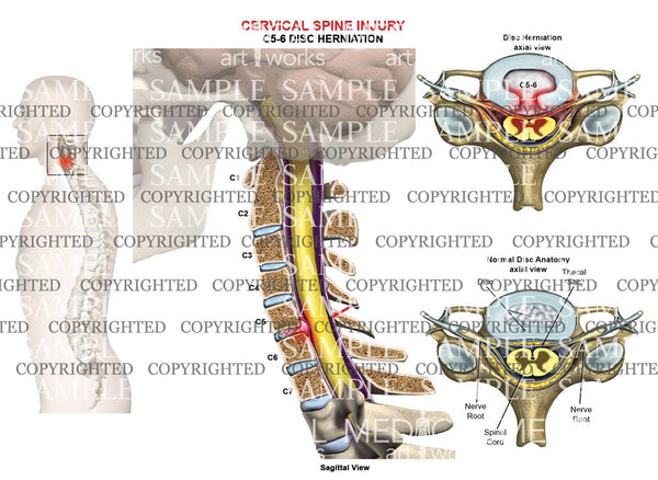 C5 6 Disc Herniation — Medical Art Works