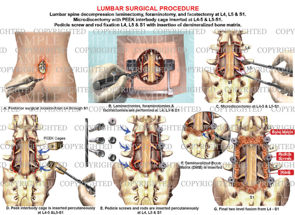 2 Level L4 L5 S1 Lumbar Interbody Fusion Decompression