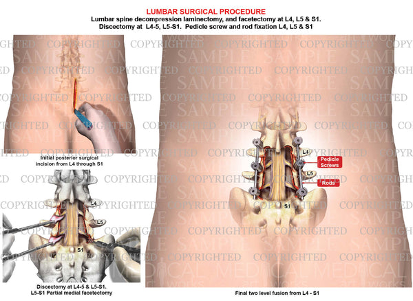 2 Level L4 5 And L5 S1 Lumbar Spine Fusion Discectomies — Medical Art