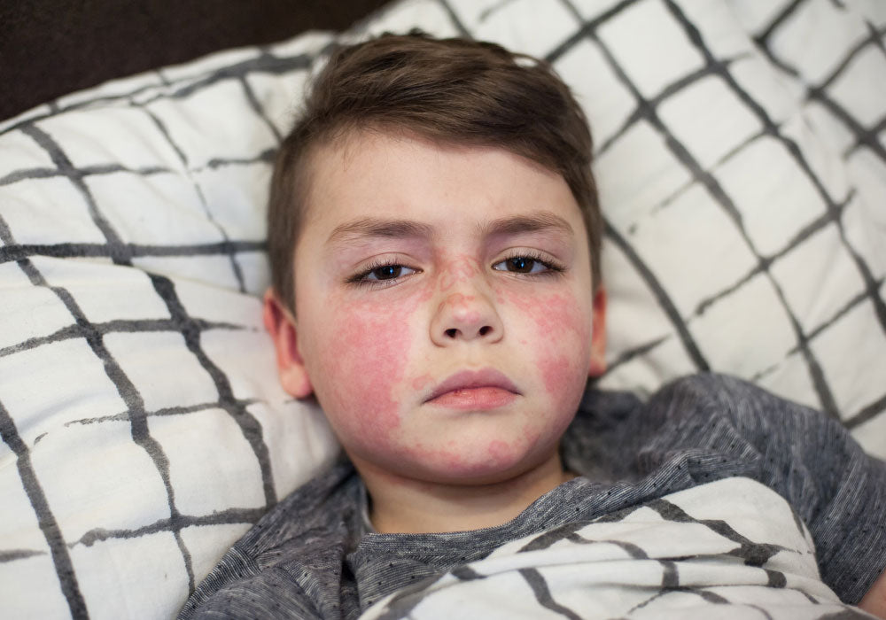 Scarlet Fever What Is Scarlet Fever Lloydspharmacy