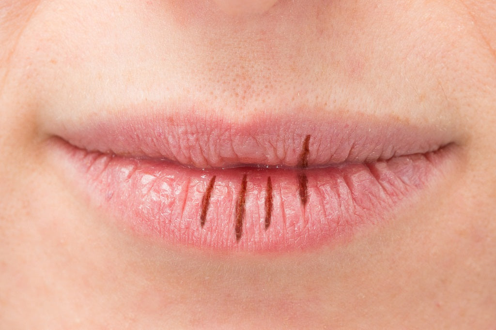 8 Natural Remedies To Get Rid Of Cracked Lips