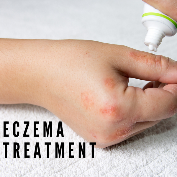 How To Get Rid Of Eczema