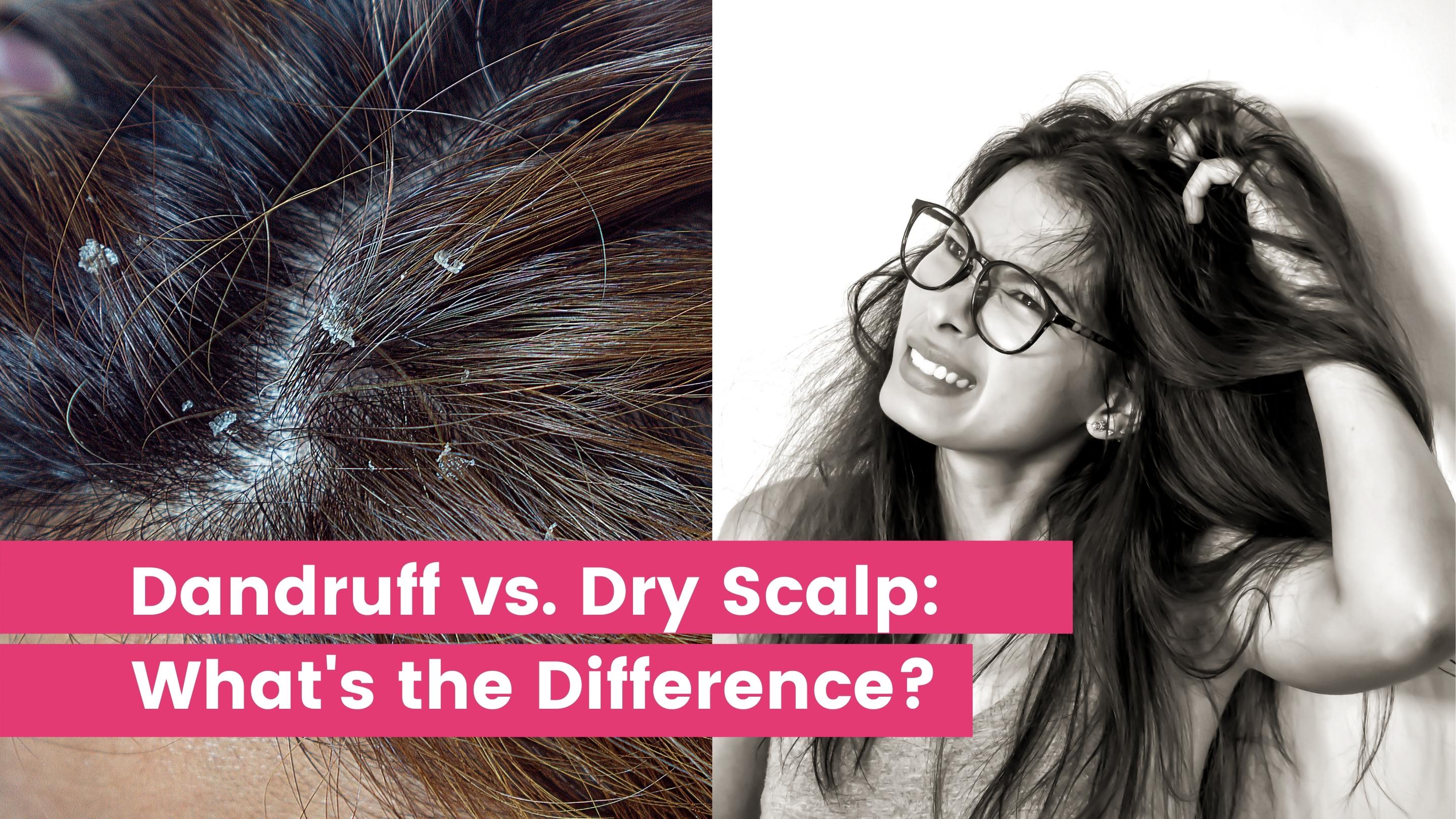 Dandruff Vs Dry Scalp