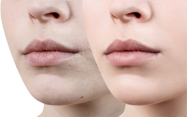 How To Reduce Redness Around Lips Considerationhire Doralutz