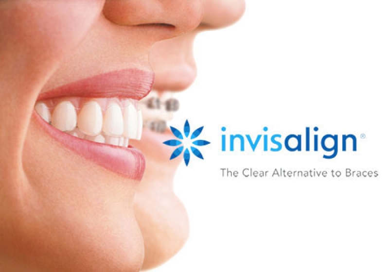 Invisalign Clear Braces Aligners For Adults Dr Aly Kanani