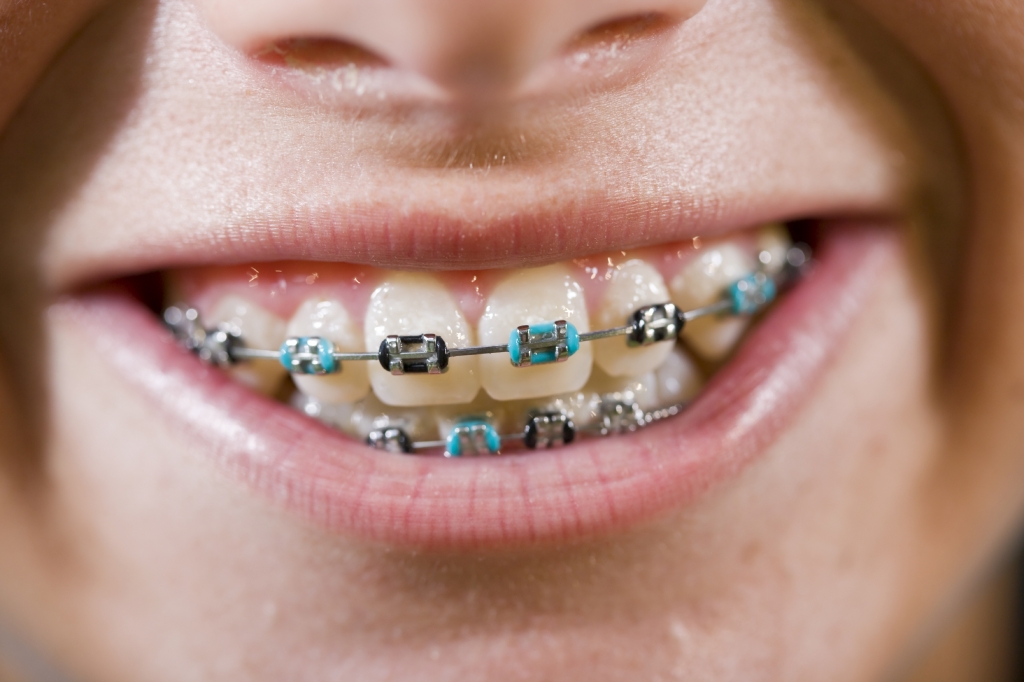 Coloured Braces Guildford Orthodontics Surrey Bc