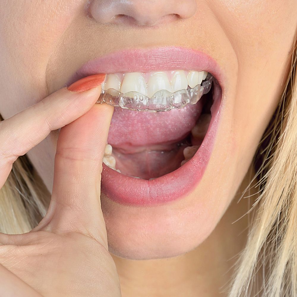 Invisalign Gap In Front Teeth