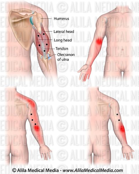 Alila Medical Media Trigger Points And Referred Pain For The Triceps