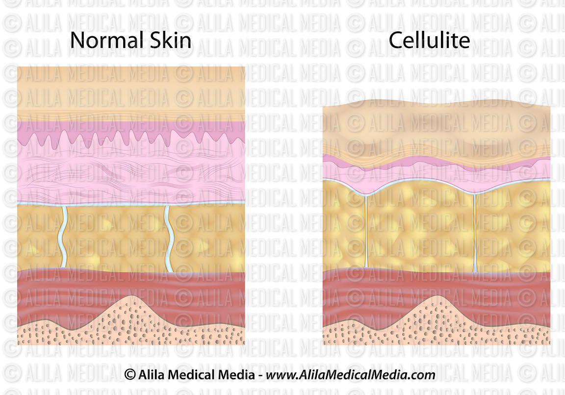 Alila Medical Media Cellulite Versus Normal Skin Unlabeled Medical