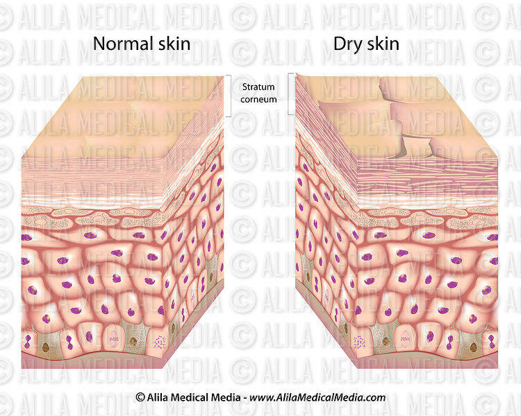 Alila Medical Media Dry Skin Medical Illustration