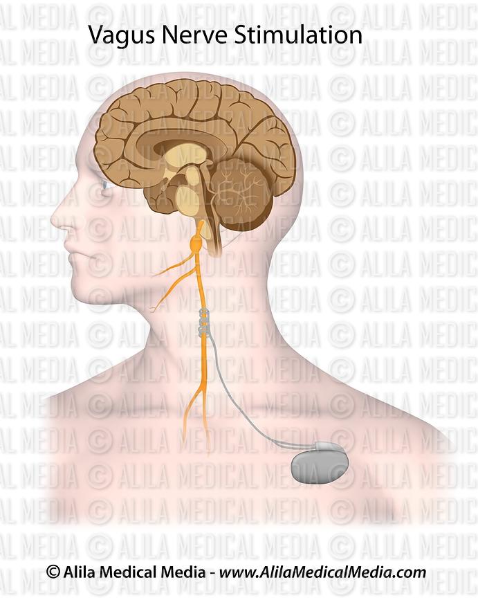 Alila Medical Media Vagus Nerve Stimulation Therapy Medical