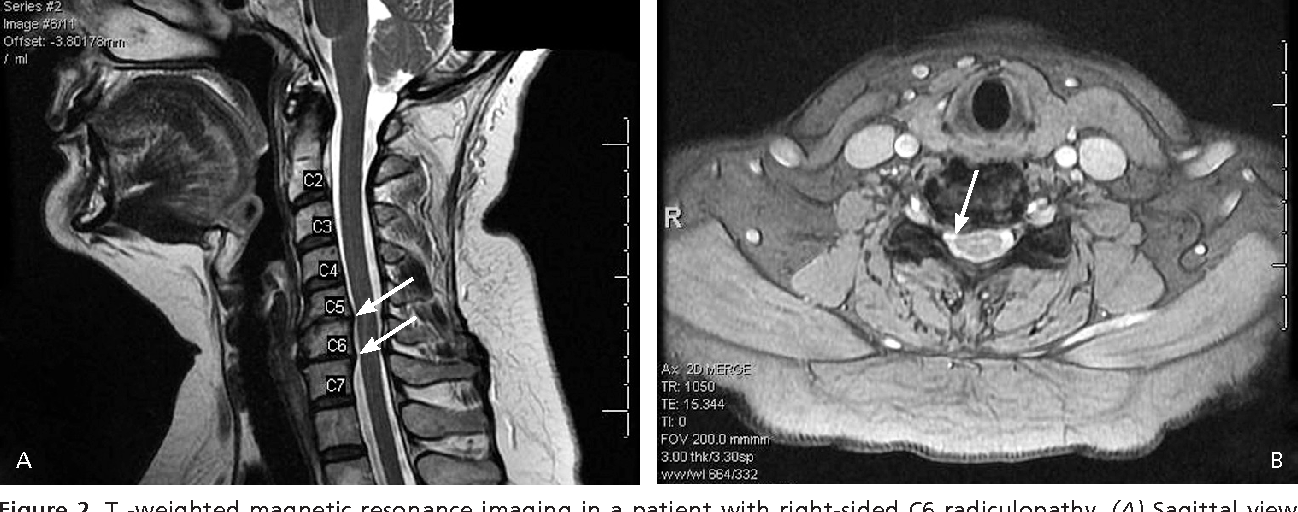 Pdf Cervical Radiculopathy Nonoperative Management Of Neck Pain And