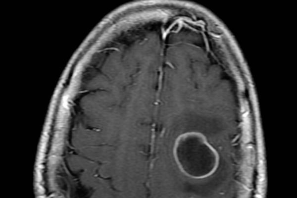 Descubren El Proceso De La Metástasis Del Cáncer Cerebral