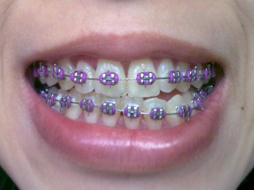 Braces Colors What Are Best Colour For Braces Dentist Says