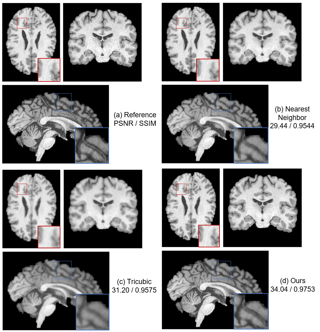 Github Snailpongmrisuperresolution3dgradientfilterlearning An