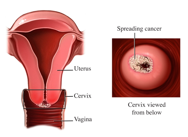 Github Kapeepcervical Cancer Prediction