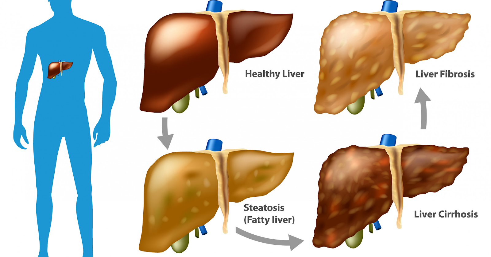 Nafld And Nash Nonalcoholic Fatty Liver Disease Nafld And Nash