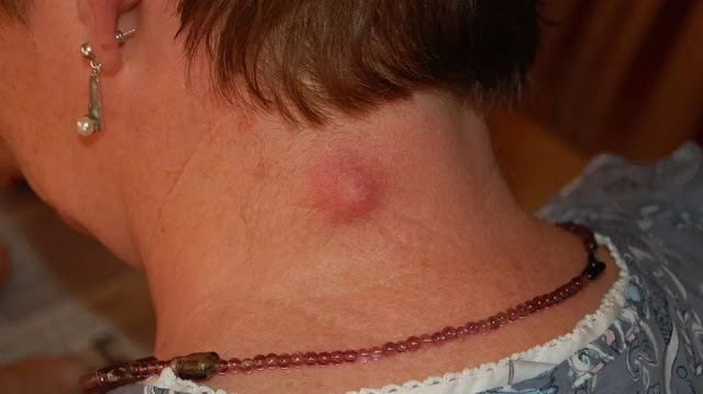 What Are Epidermoid Cysts Symptoms Causes Treatments And More