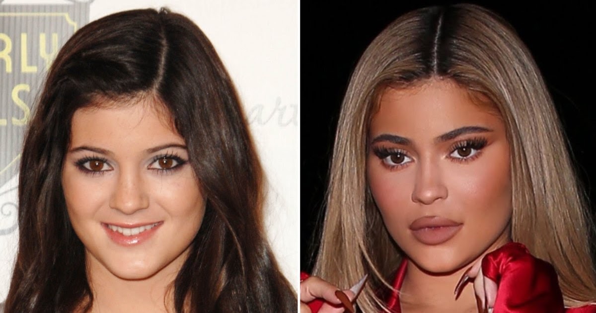 What Cosmetic Procedures Has Kylie Jenner Gotten Done