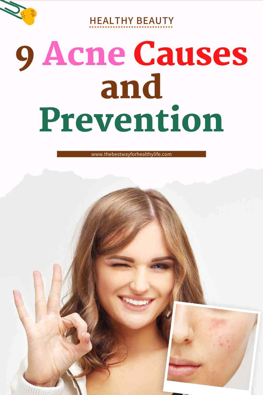 Acne Causes And Prevention