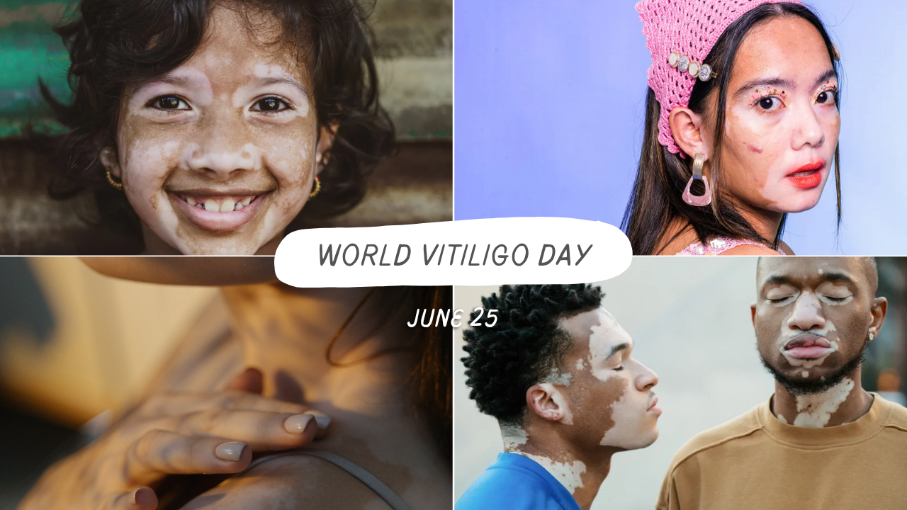 World Vitiligo Day 2022