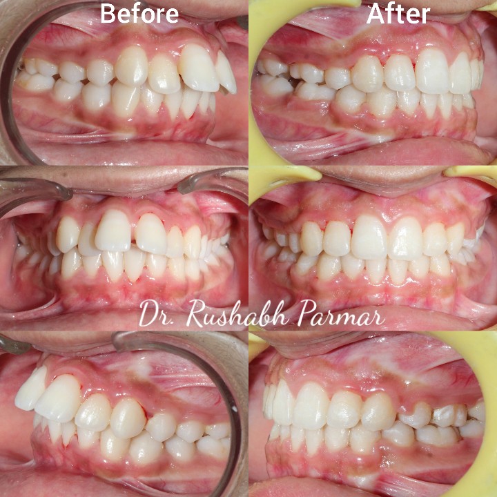 Orthosmile Multispeciality Dental Clinic Management Of Class Ii