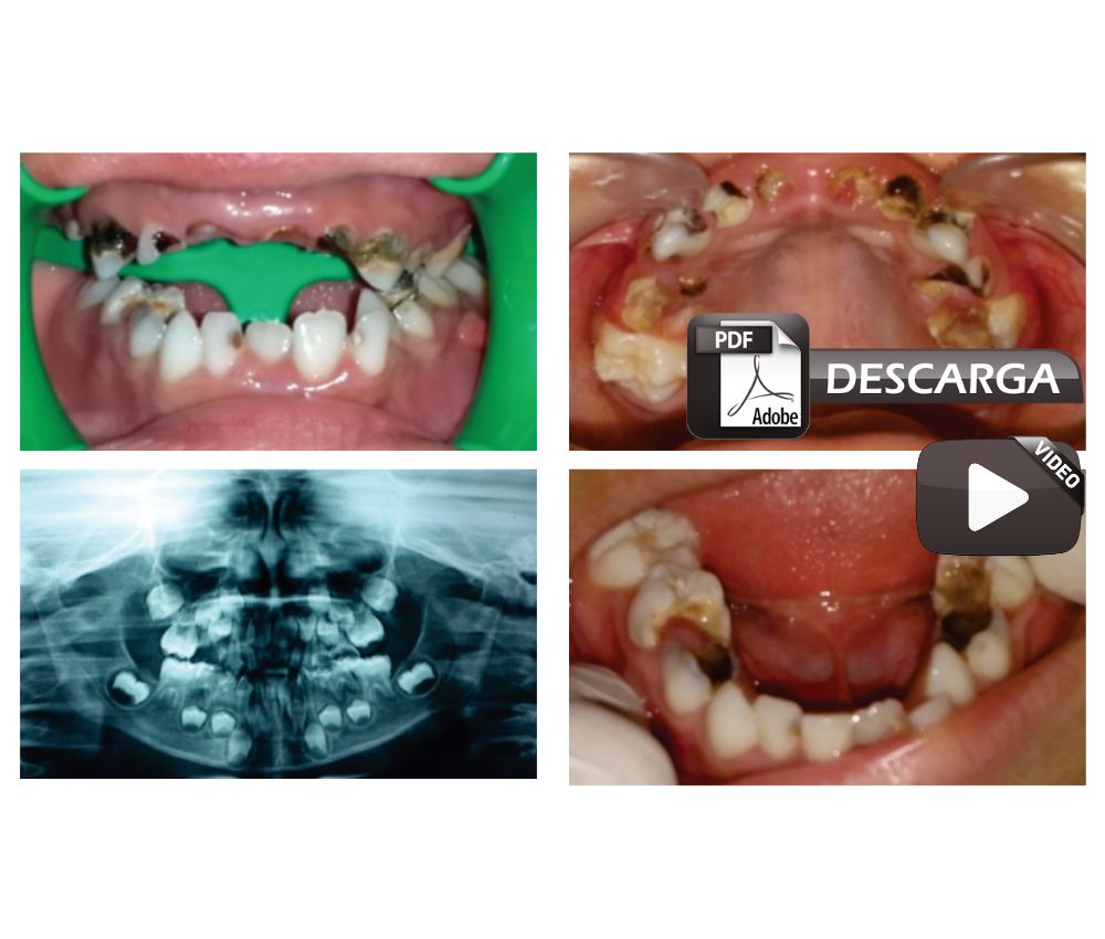 Caries Temprana De La Infancia Características Factores Y