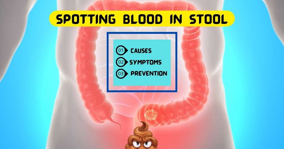 Spotting Blood In Stool Causes Symptoms And How To Prevent It