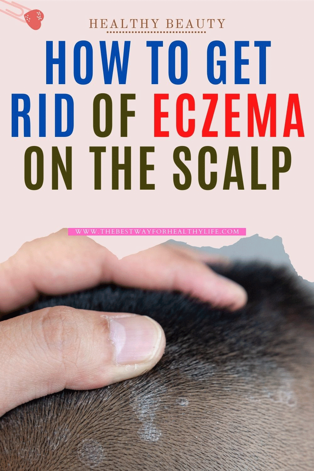 How To Get Rid Eczema On The Scalp