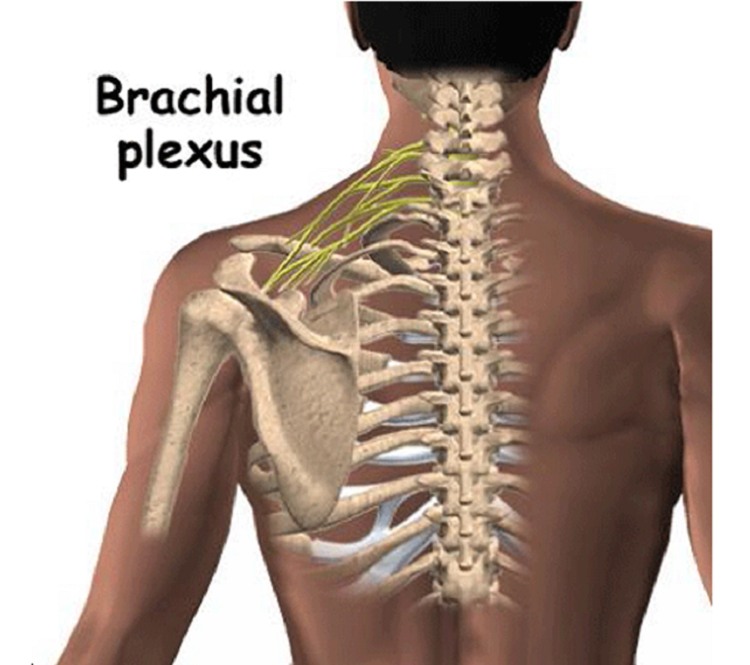 Brachial Plexus Injury Diagnosis And Treatment