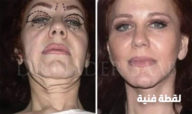 طبيب ينشر صورة للمطربة ميادة الحناوي قبل التجميل تصيب جمهورها