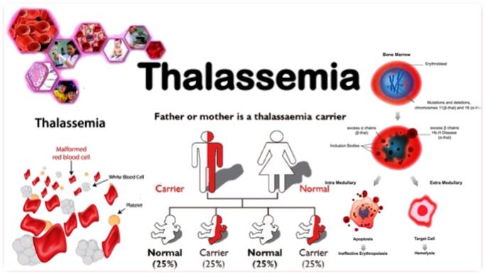 Understanding Thalassemia Minor Symptoms Treatment And Genetic