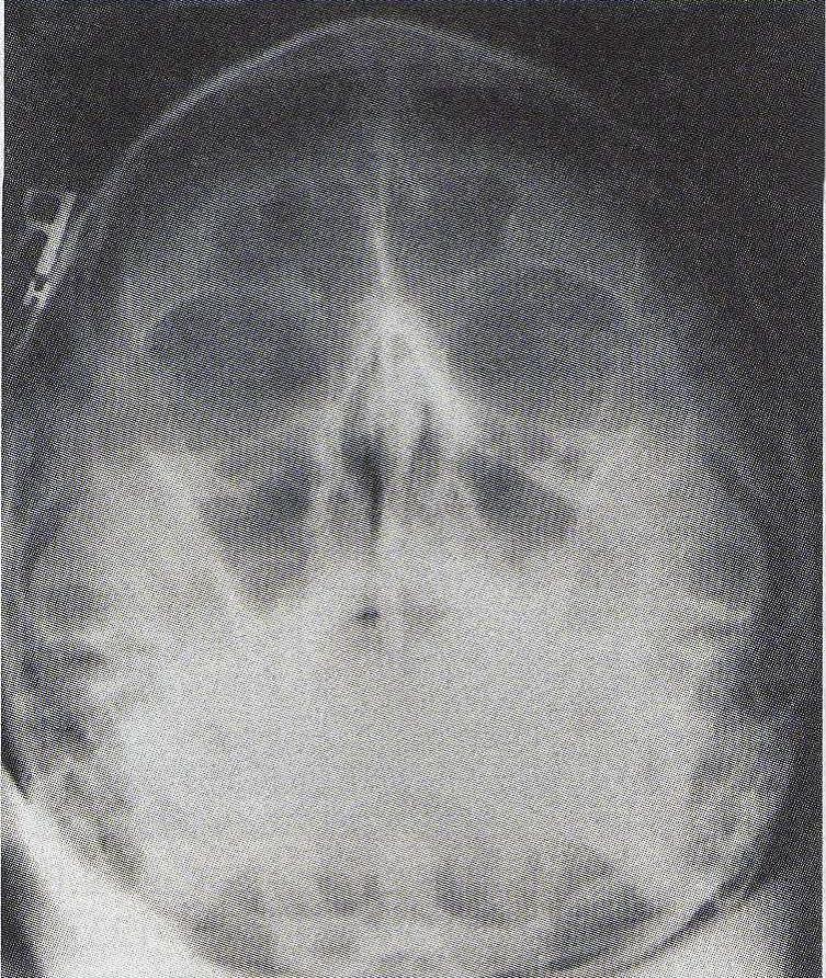 Prosedur Pemeriksaan Radiografi Sinus Paranasal Zona