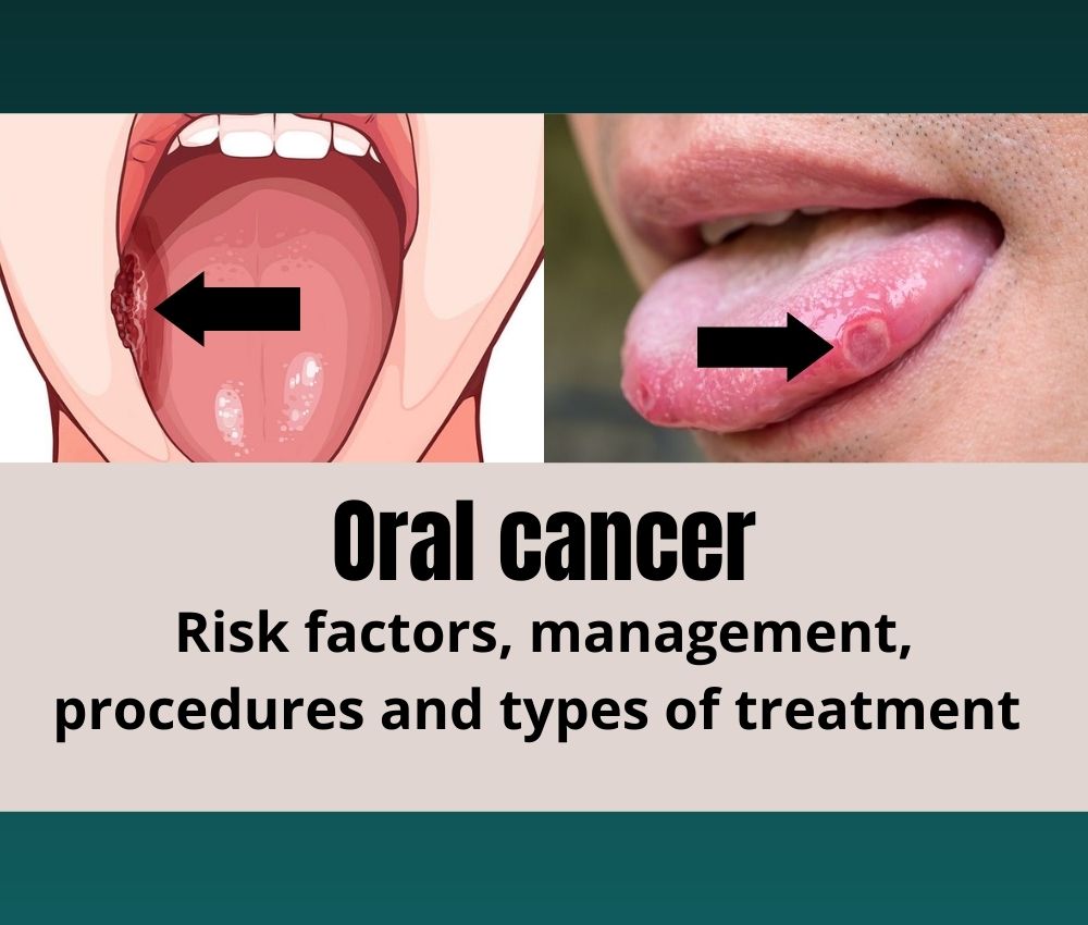 Oral Cancer Risk Factors Management Procedures And Types Of