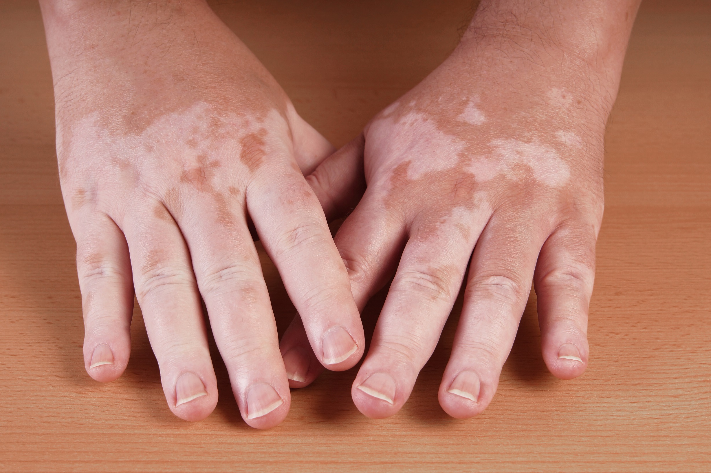 Vitiligo Quais As Principais Características Desta Doença Dermatológica