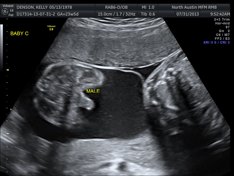 The Texas Trio A Triplet Pregnancy Blog Ultrasound Pics