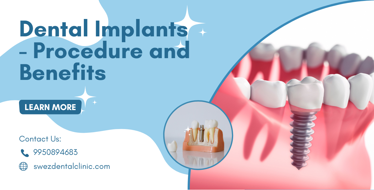 Dental Implants Procedure And Benefits