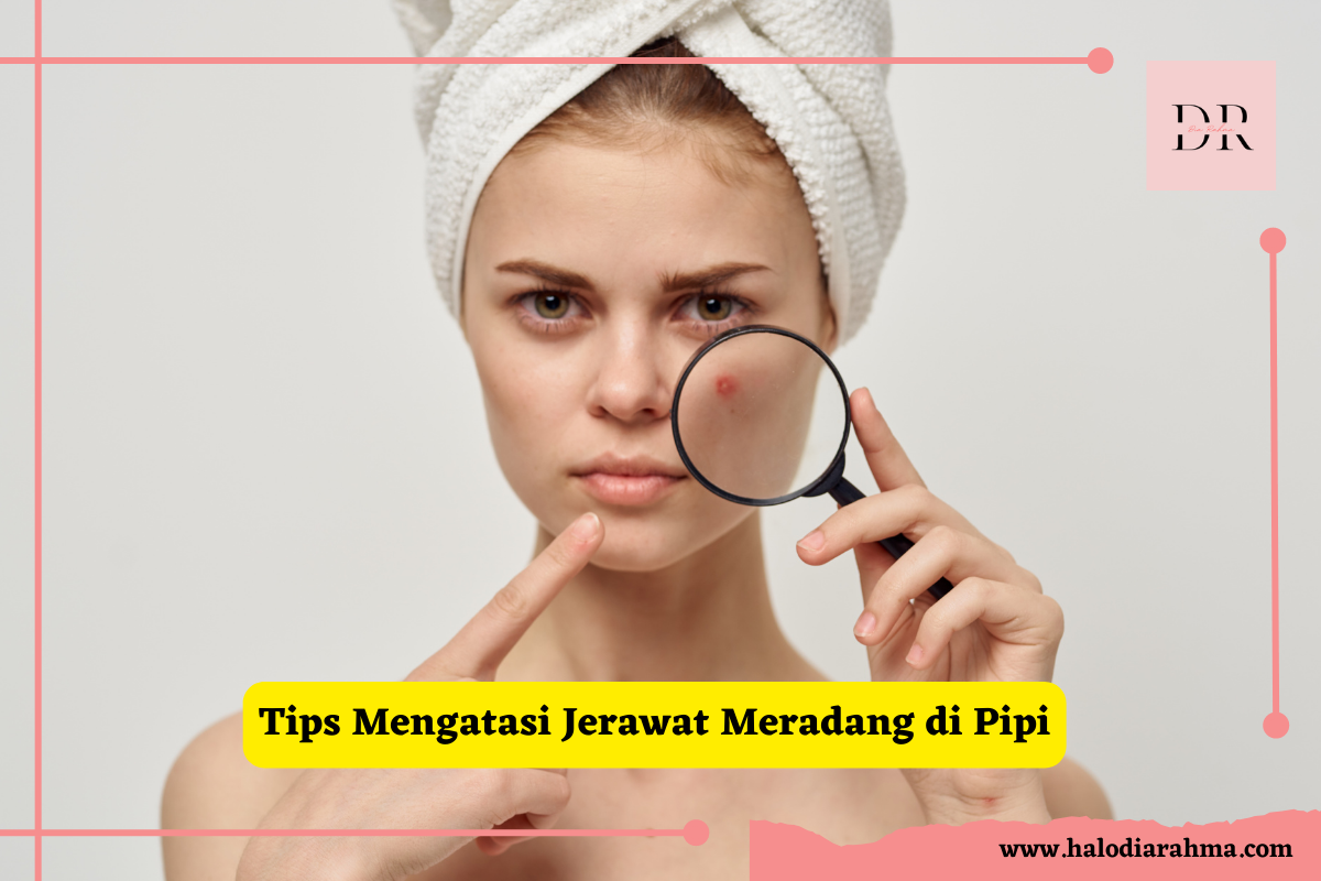 Tips Mengatasi Jerawat Meradang Di Pipi