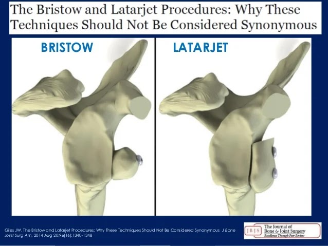 What Is The Difference Between Bristow And Latarjet Procedure