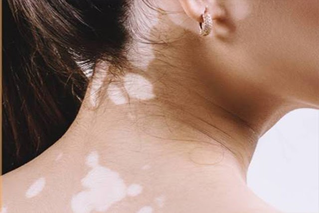 Understanding Vitiligo Causes Symptoms And Treatments