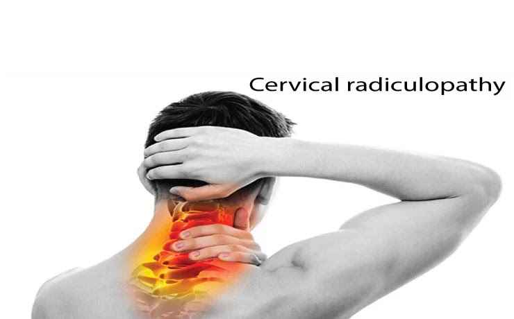 Cervical Radiculopathy Learning Tree