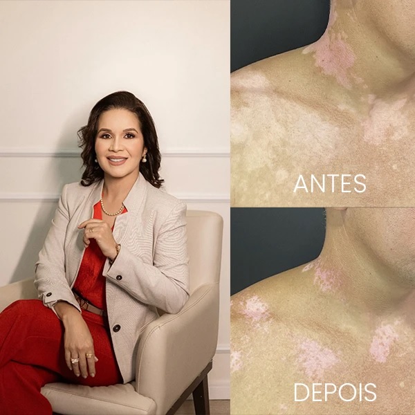 Vitiligo Conheça A História De Seu Francisco E Entenda Melhor A Doença