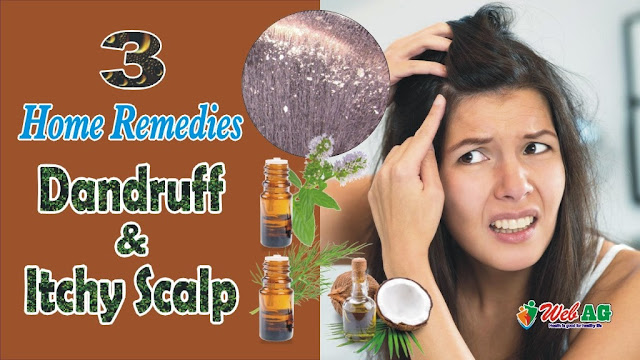 3 Home Remedies For Dandruff And Itchy Scalp ~ Webag