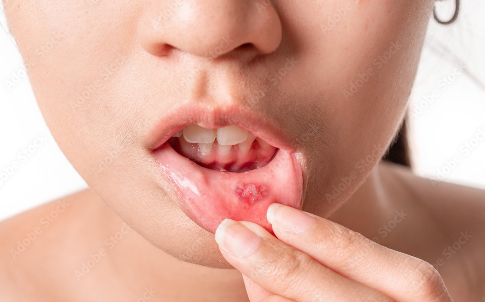 Mouth Ulcers Causes Prevention Treatment And Home Remedies