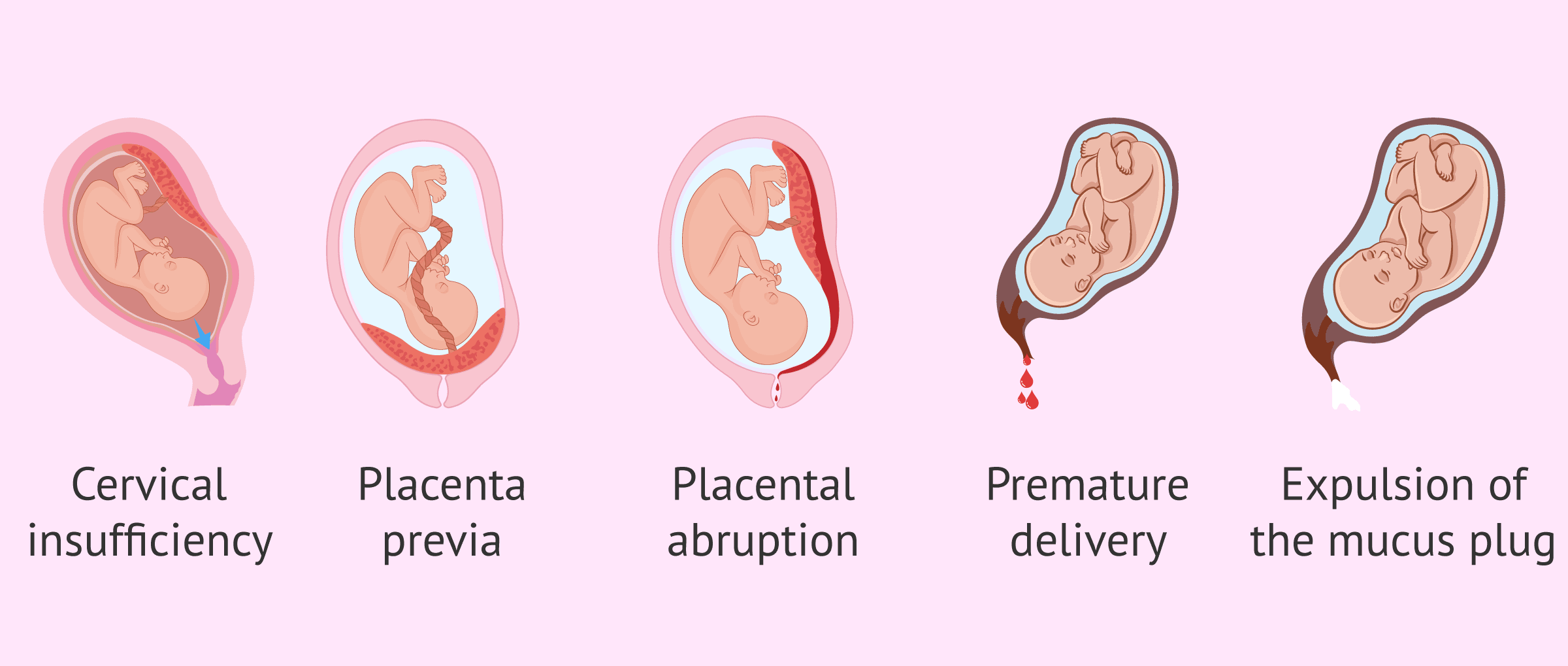 Bleeding And Spotting From The Vagina During Pregnancy