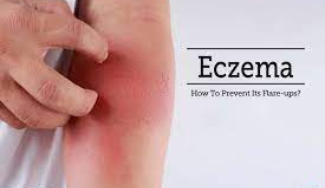 Preventing Eczema Flare Ups Strategies For Each Type Of Eczema